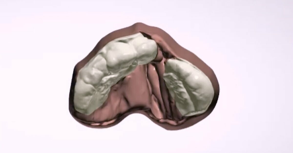 Labio y paladar fisurado Luna video6a