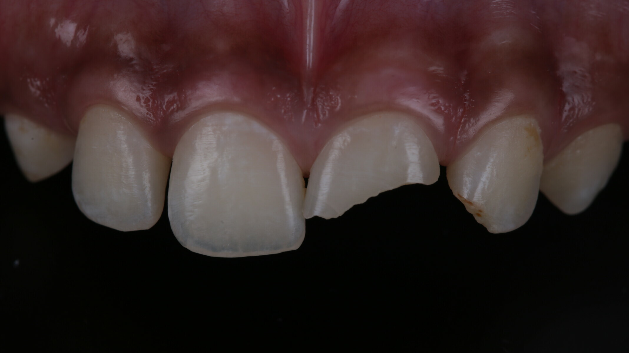 DT News - India - Polychromatic Layering Technique (PLT)—full protocol ...