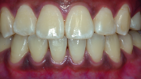 Dental News - Non-ablative melanin depigmentation of gingiva