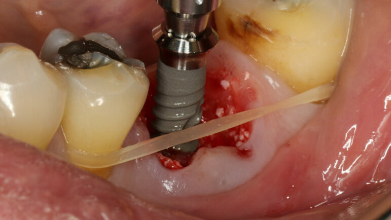 Immediate placement and loading of Straumann TLX