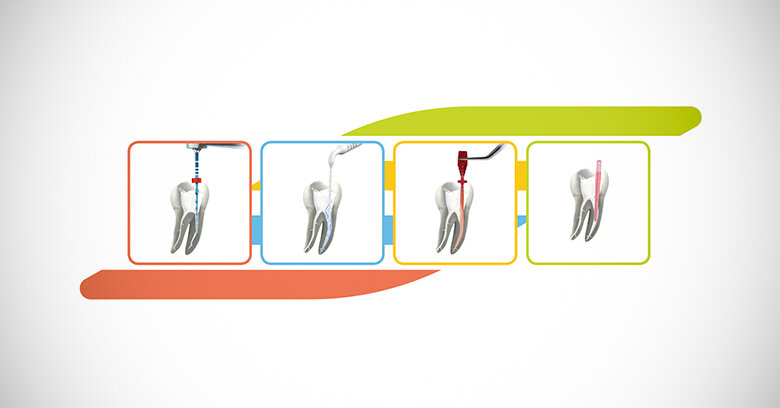 VDW Endo-System promises easy root canal therapy in four steps