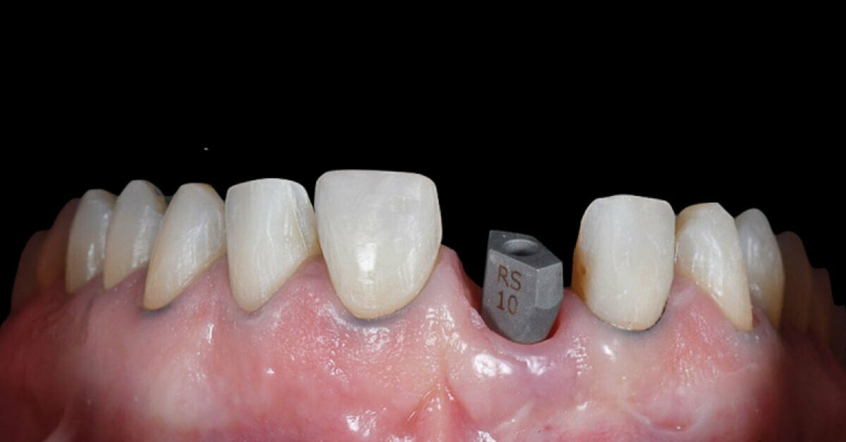 Klinische casus: Invisalign Smile Architect software