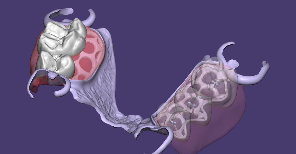 Exocad releases PartialCAD 3.1 Rijeka, new functionalities