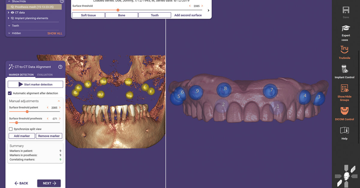 Dental News - Exocad releases exoplan 3.0 Galway software in the US