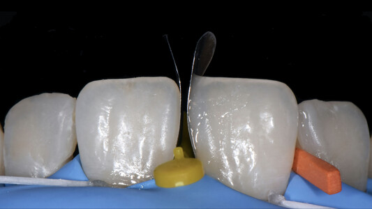 Diastema closure using a direct two-matrix technique
