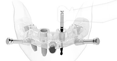 Nobel Biocare – NobelGuide