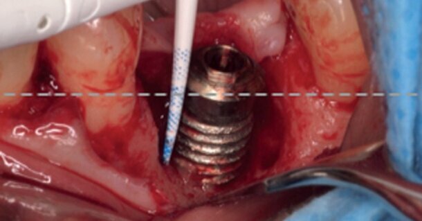 Dental News - Surgical treatment of circumferential and ...