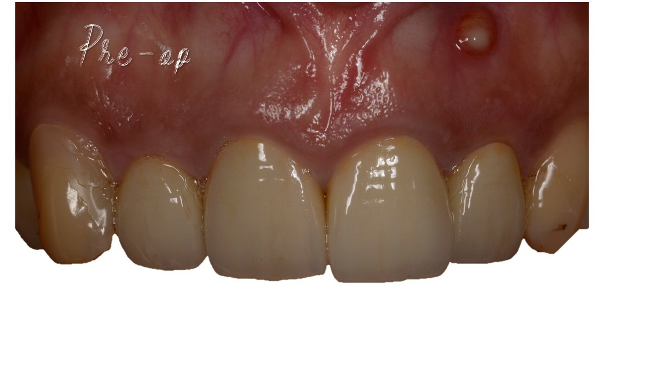 Saving Seemingly Hopeless Teeth In Aesthetic Zone: Team Approach : Dr ...