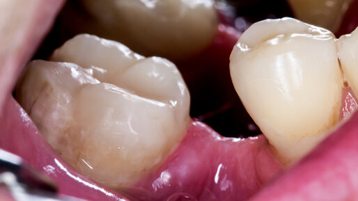 Growing new teeth: Will “every dentist’s dream" come true?