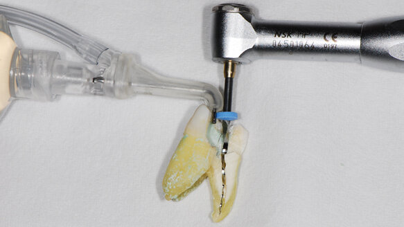 Dental News - Improving endodontic success through use of the EndoVac ...