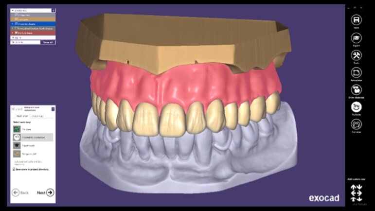 New software available for fabrication of complete dentures