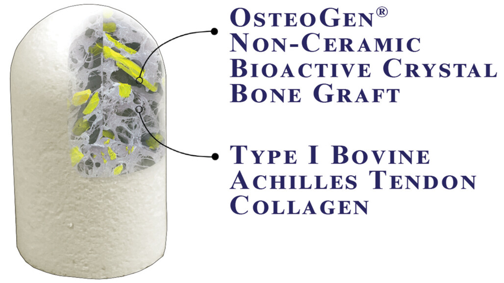 The OsteoGen Plug: One-step bone grafting solution for socket ...