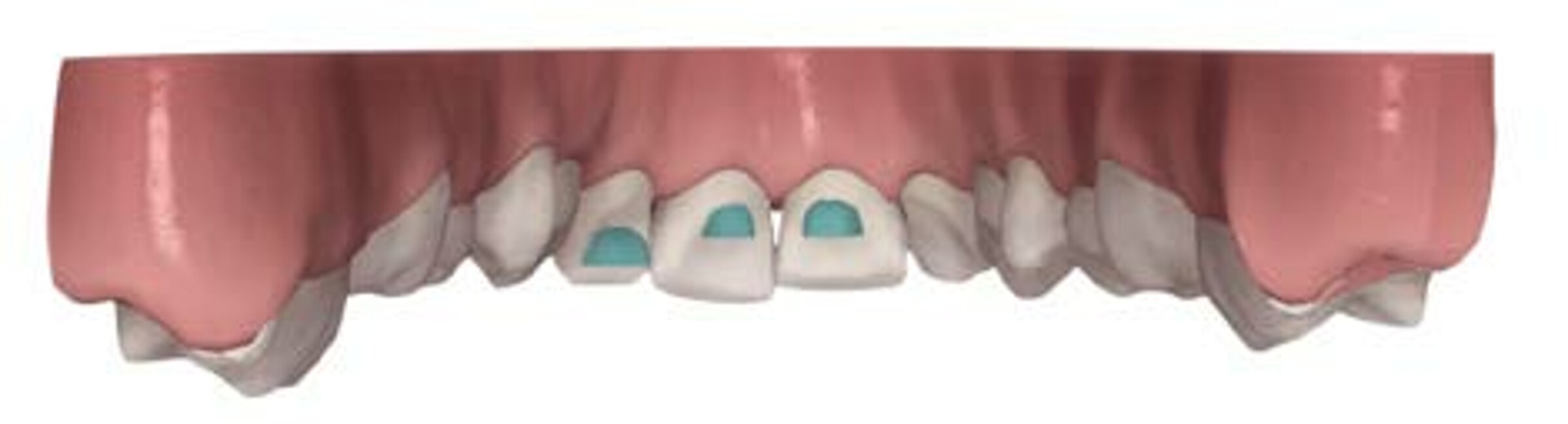 Proper curve of Spee levelling