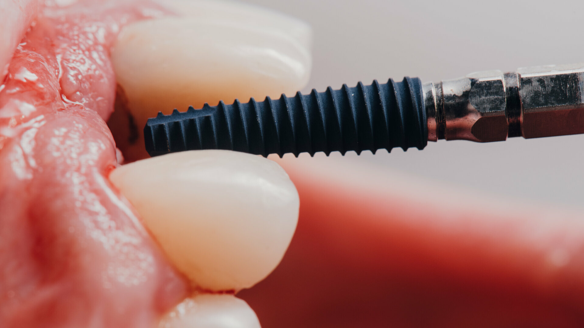 Yomi robotic system gains ground in dentistry