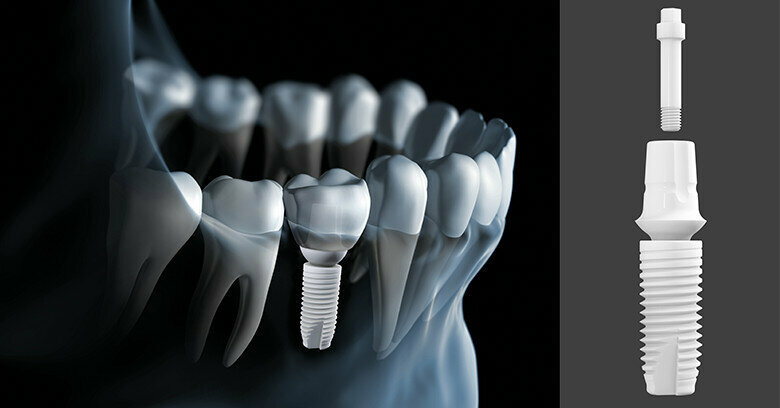 Straumann partners with Z-SYSTEMS to offer widest range of ceramic implants