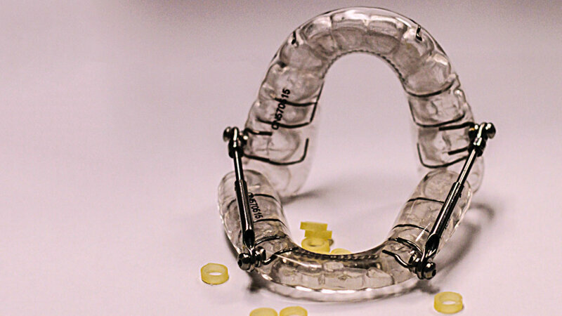DT News - Latin America - Aparatología de avance mandibular para Apnea ...
