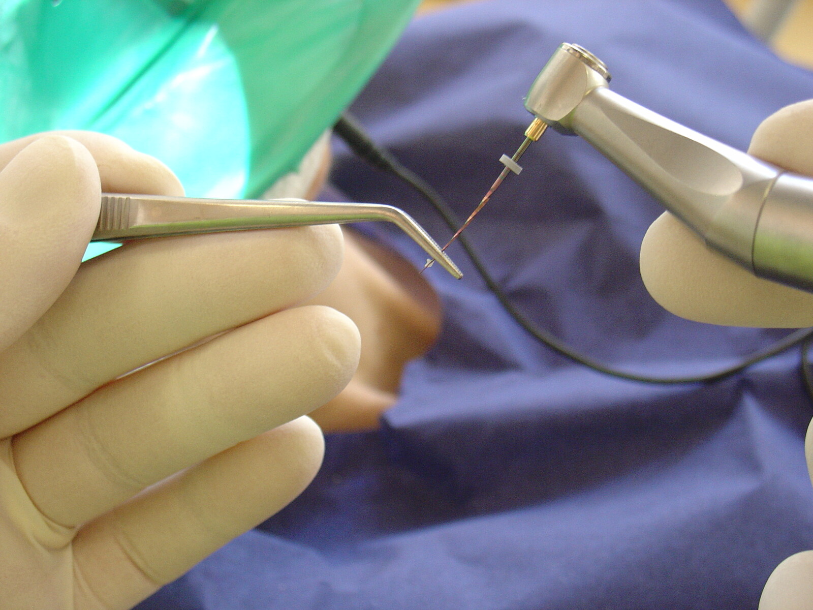 Endodontic follow-up in strongly curved root canals