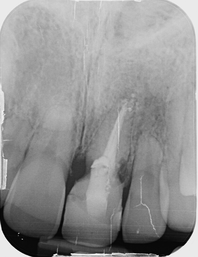 Fast, functional aesthetic solution for anterior tooth trauma