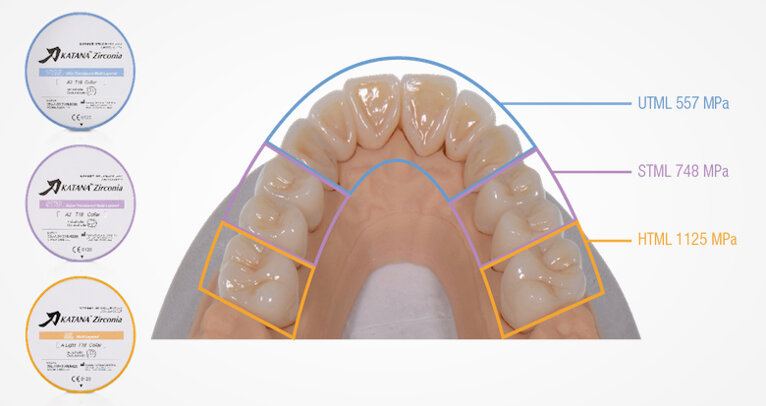 Multilayered zirconia in different translucency levels