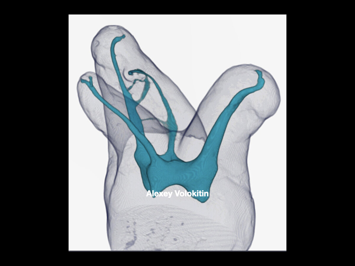 Clinical management of maxillary second molar root canal therapy in ...