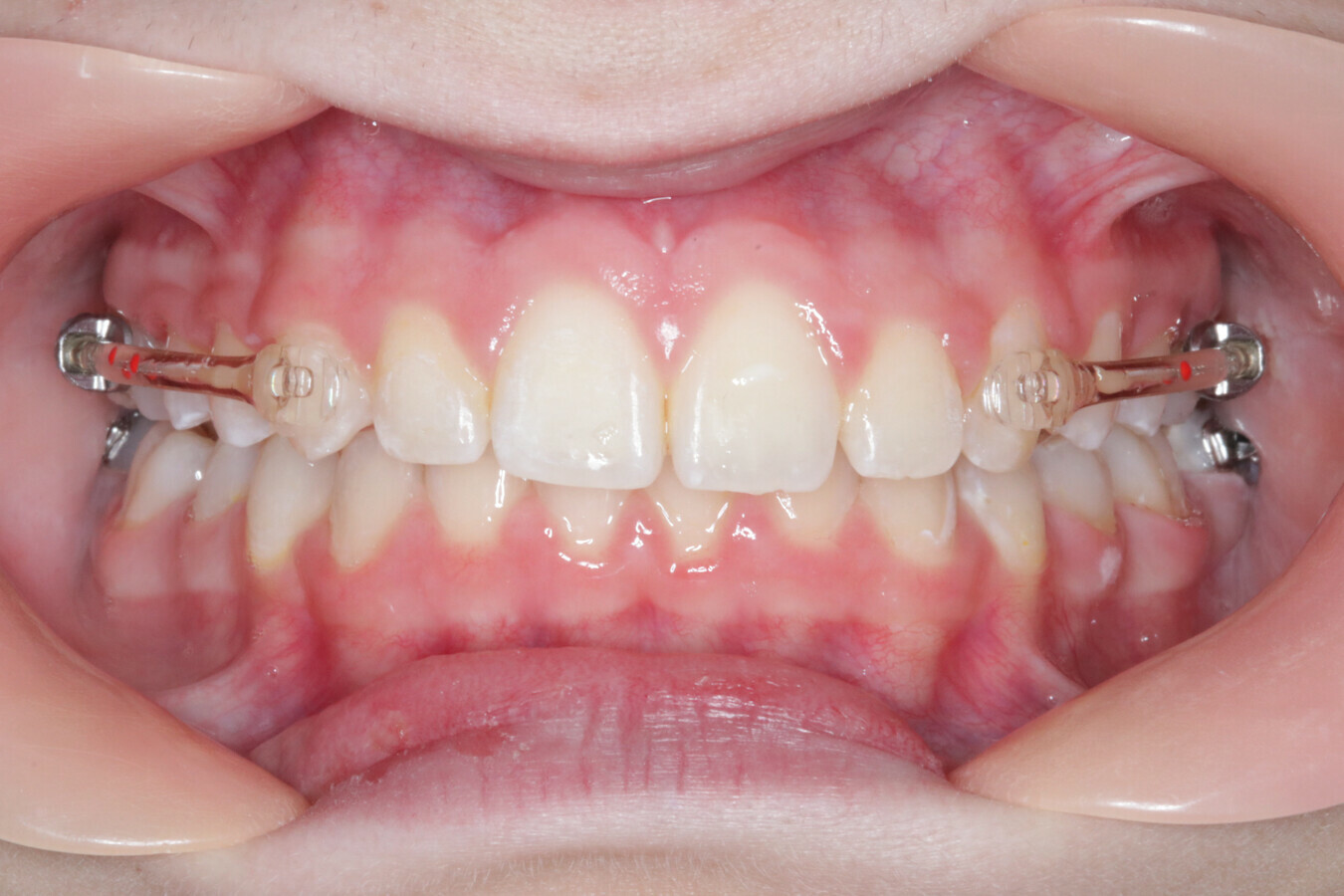 Boosting facial aesthetics through a hybrid approach of the Carriere Motion appliance and Reveal ...