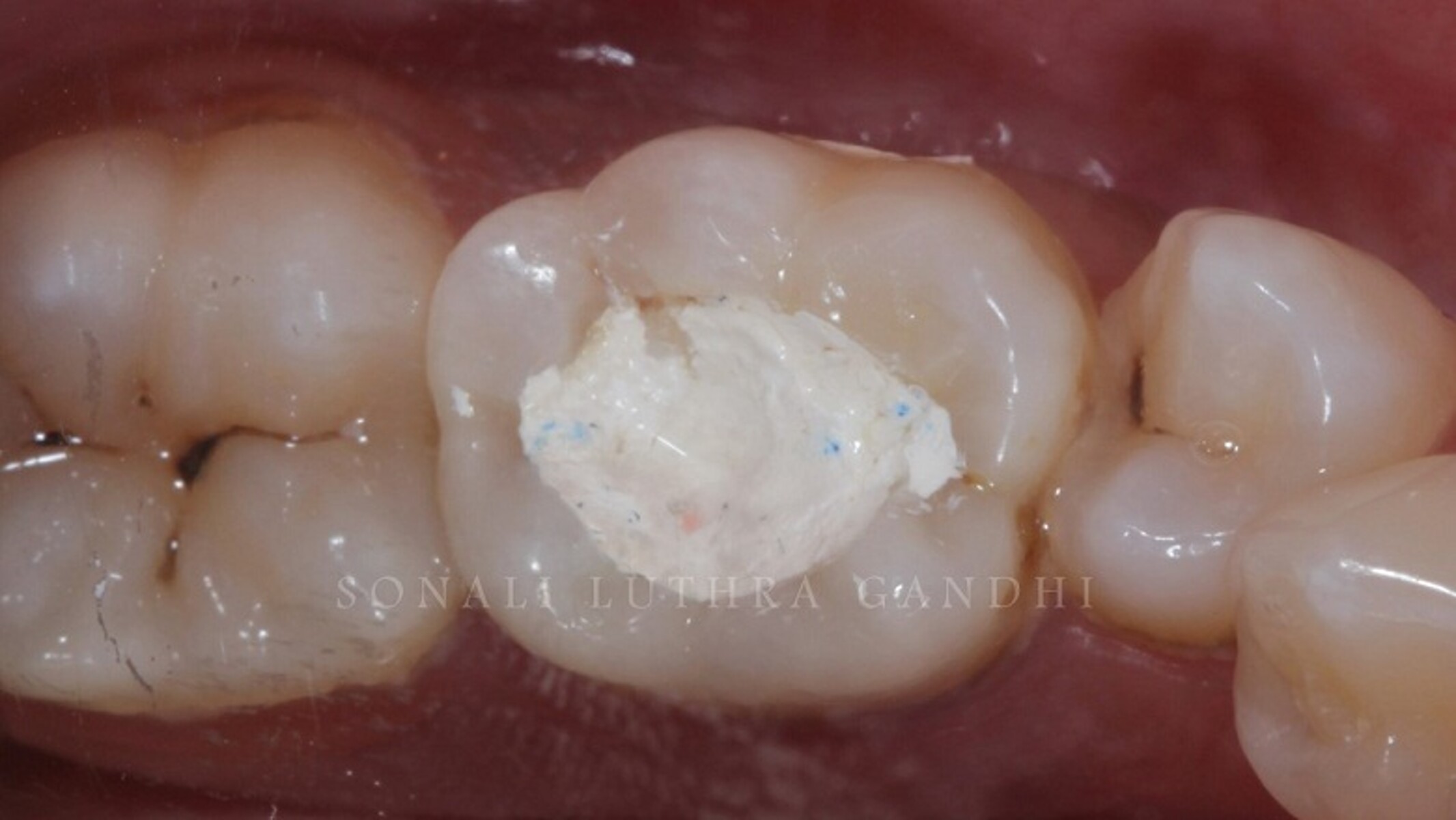 Cuspal layering Technique