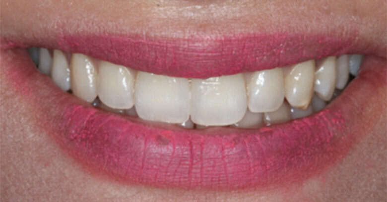 DT News - MEA - A step-by-step guide to a direct diastema closure. Case ...