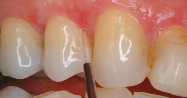 Dental News - Diode lasers for periodontal treatment: the story thus far