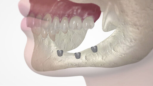 Bredent medical presents ultrashort dental implant