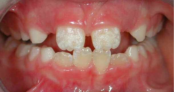 Shovel-shaped incisors a result of genetic mutation from last ice age
