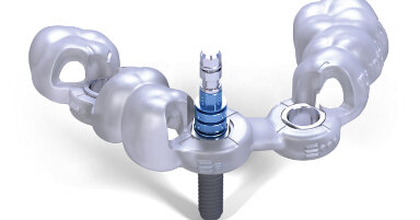 Straumann Guided Surgery