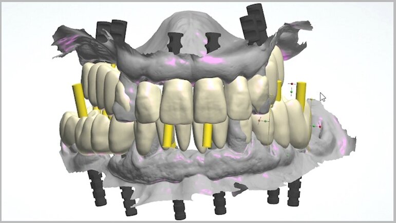 Dental News - The fully digital Pro Arch protocol