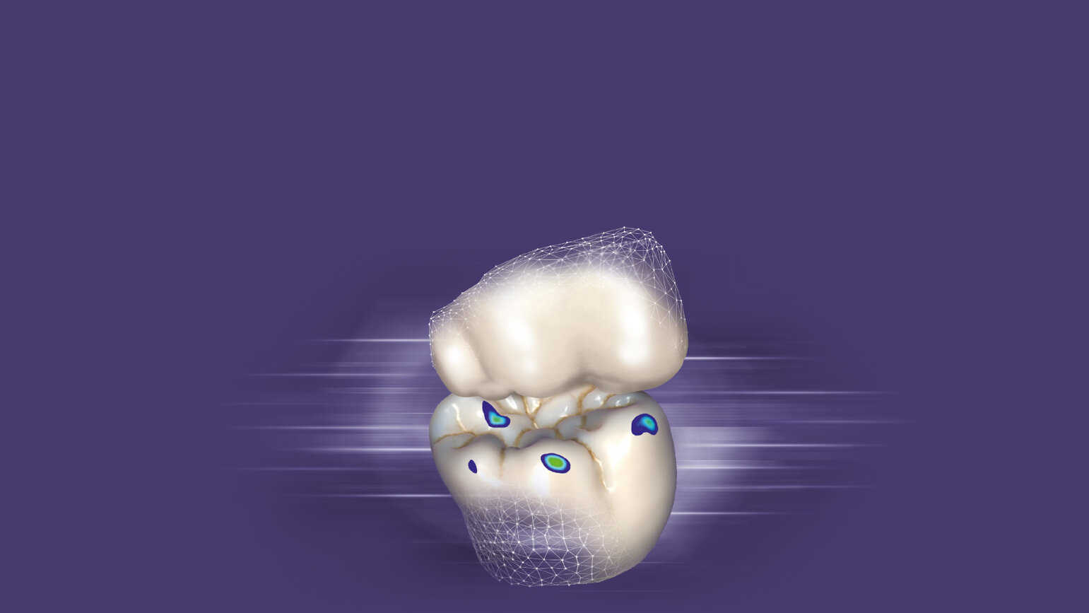 DT News - International - Reduce design time with exocad’s DentalCAD 3. ...