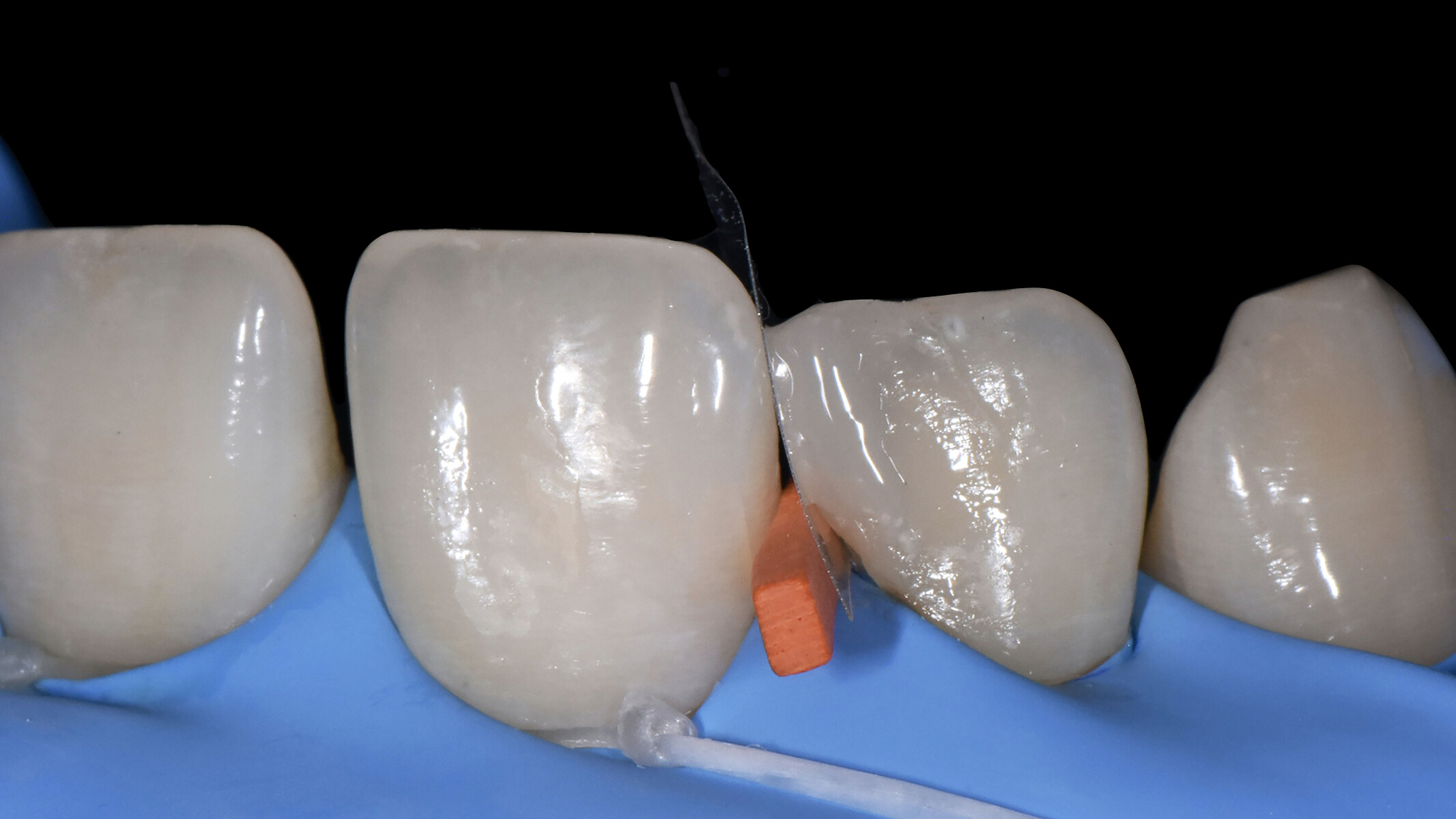 Diastema closure using a direct two-matrix technique