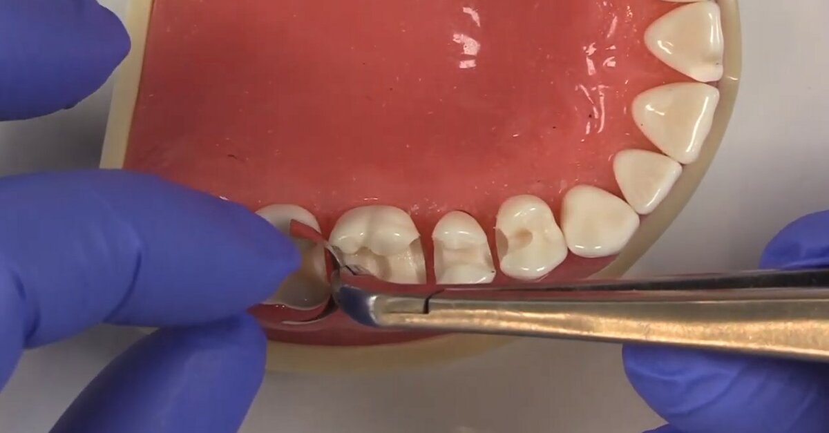 Improve Your Matrix Band Placement with This Quick Tip