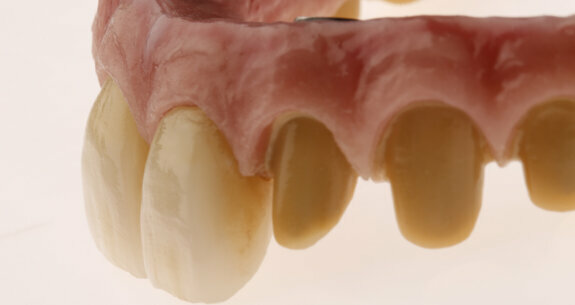 Lithium disilicate, the restorative material of multiple options