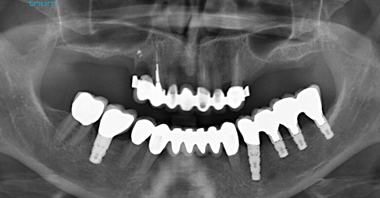 DT News - MEA - CBCT bone-densitometry for pre-surgical decision-making