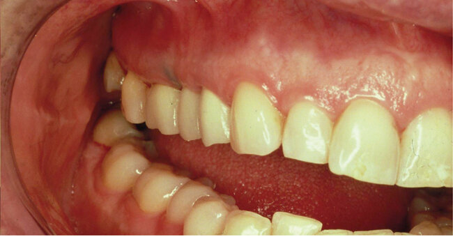 Cosmetic periodontal surgery: pre-prosthetic soft-tissue ridge ...