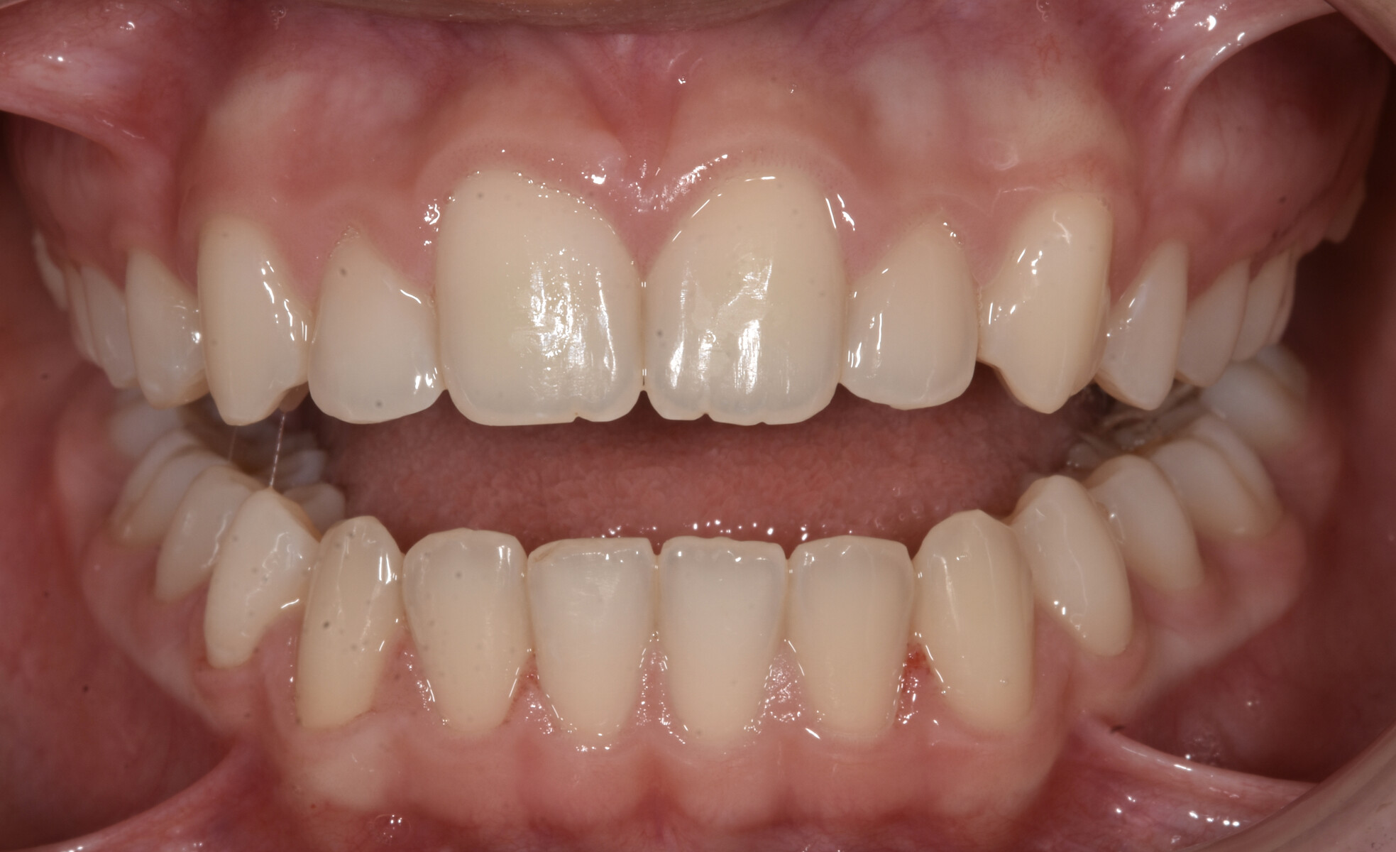 DT News - International - Addressing smile aesthetics with digital ...