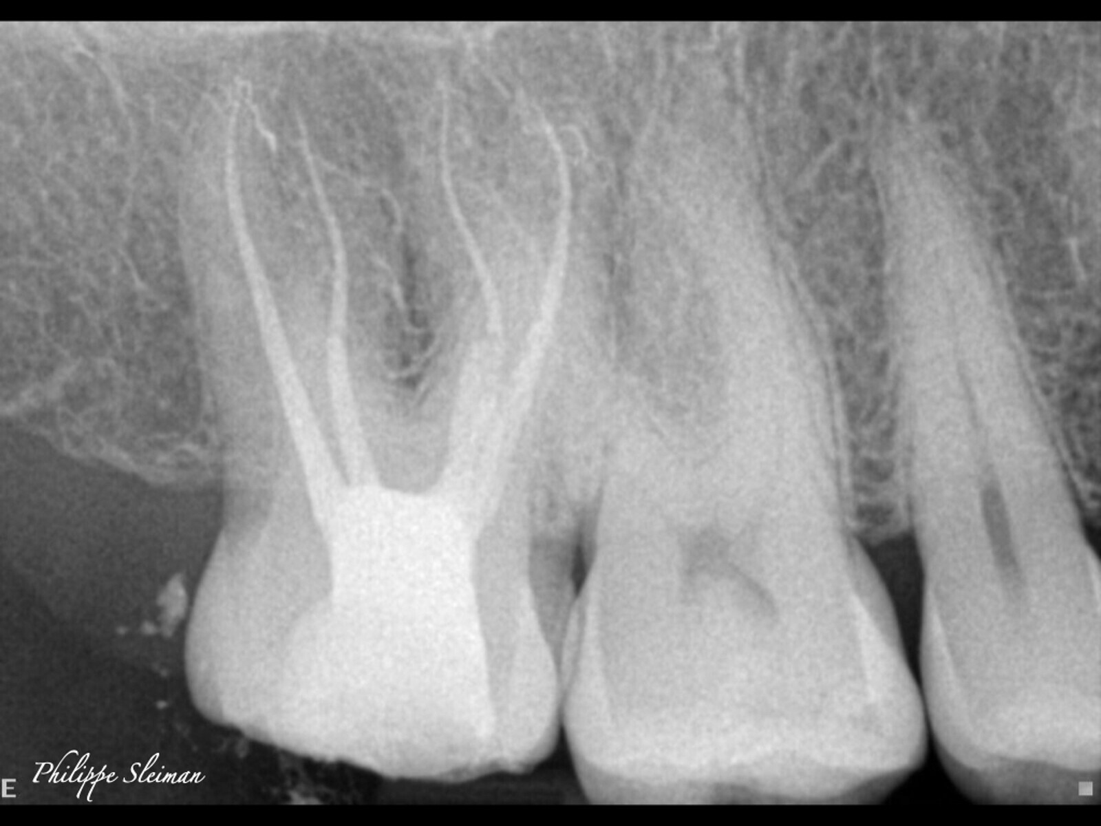 Clinical management of maxillary second molar root canal therapy in ...
