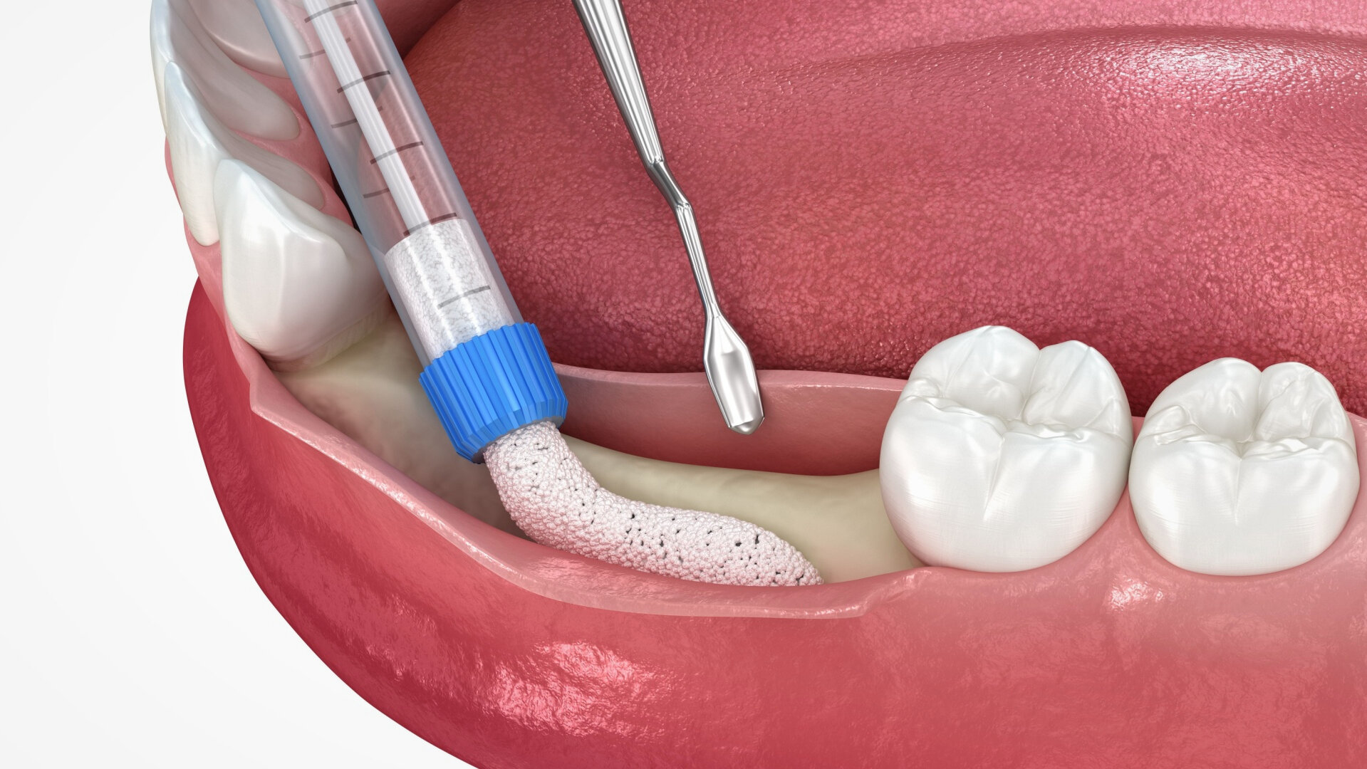 Webinar to focus on peri-implant tissue augmentation