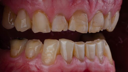 Changes to dentine during acid demineralisation